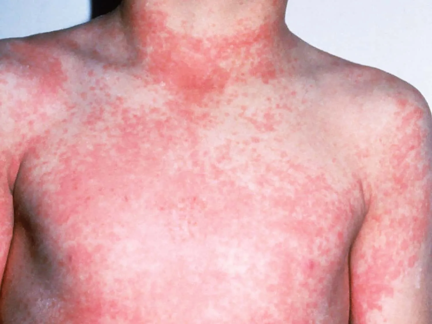 Detectan caso de escarlatina en liceo de Talca: ¿Qué es, cómo se ...